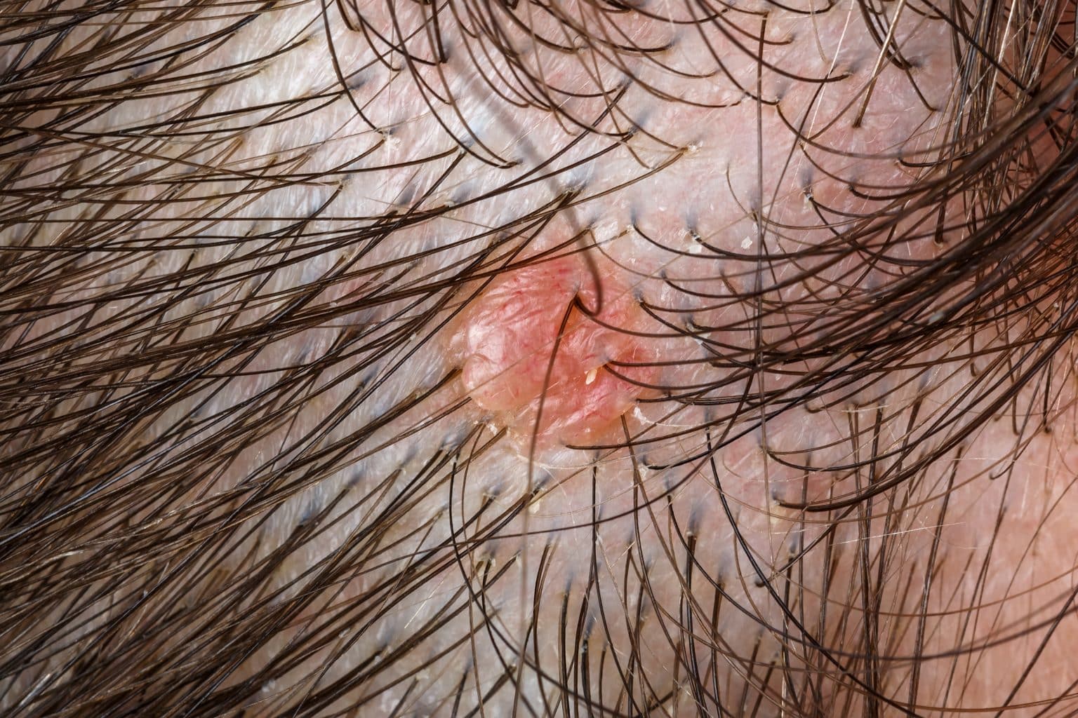 Cysts – DermAlly