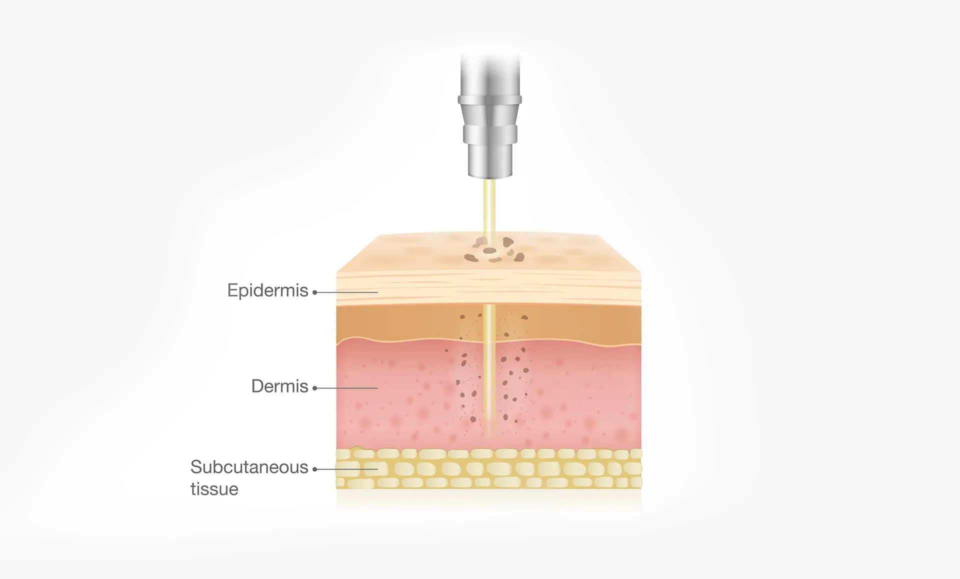 How Lasers Target Pigmentation Beneath the Skin