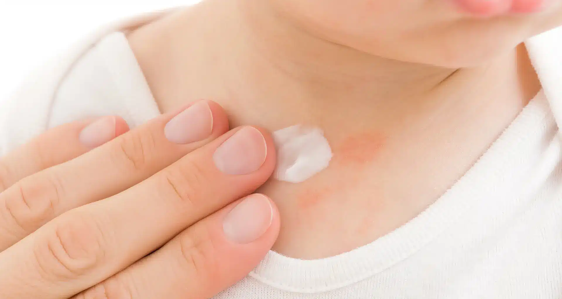 Paediatric Dermatology Singapore | Kids Eczema Specialist