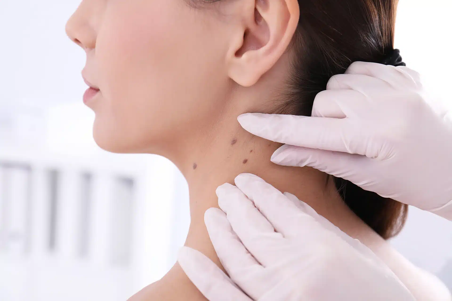 Medical vs Cosmetic Mole Removal: What’s the Difference?
