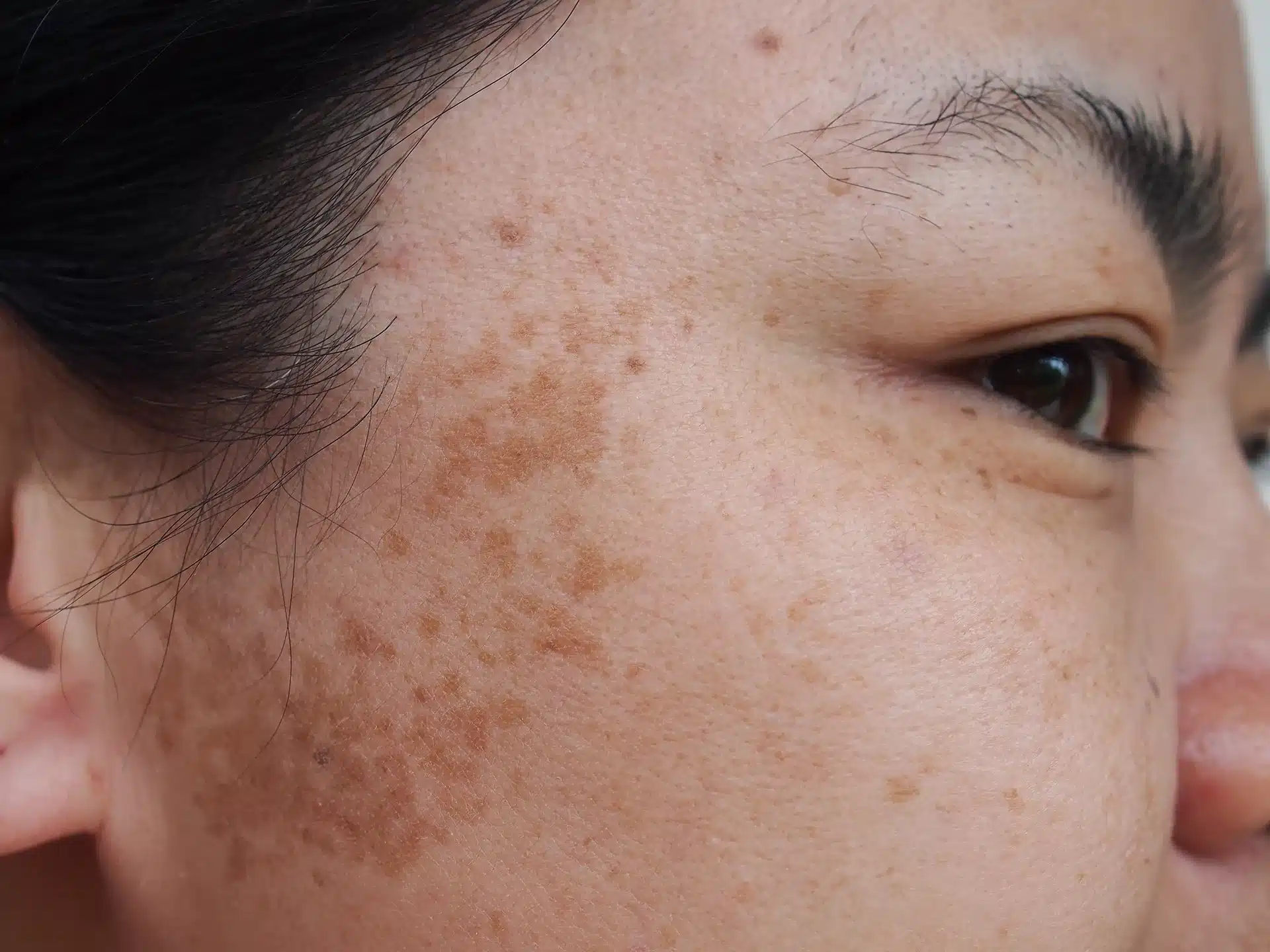 Melasma Treatment: Why It’s So Stubborn & What Actually Works